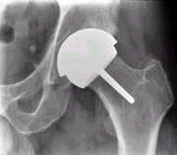 Birmingham Hip Resurfacing (BHR) Hip Implant - McGartland Law Firm